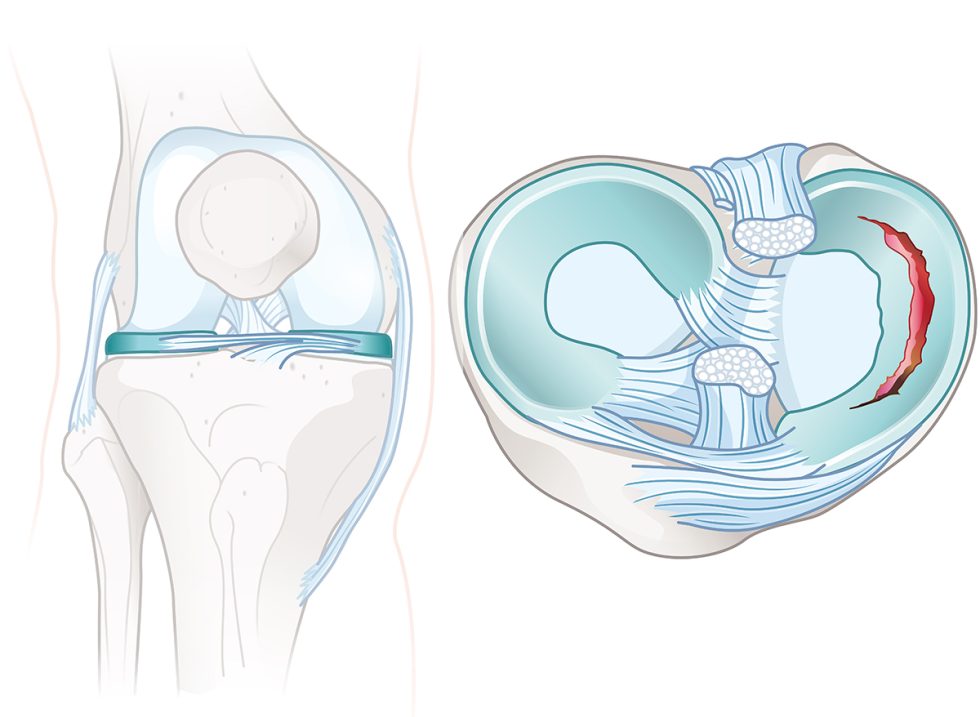 Meniscal Tear