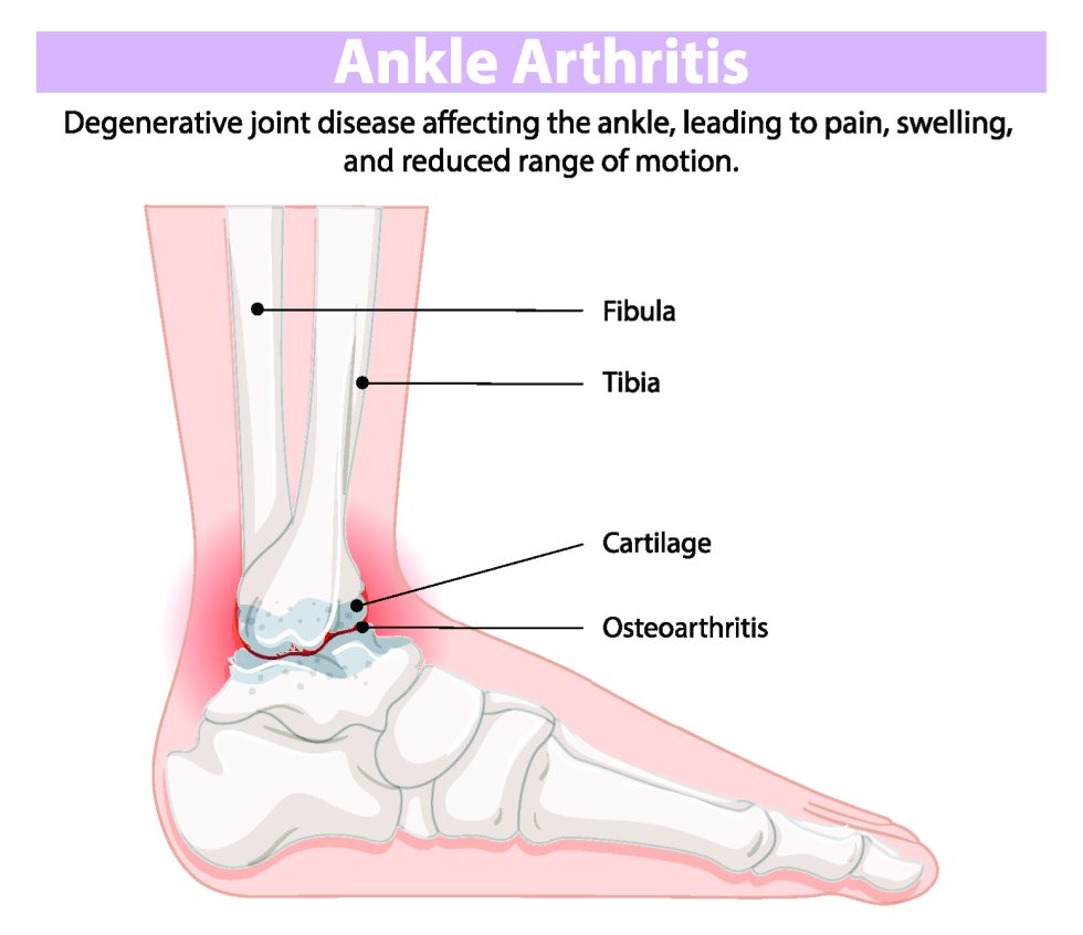 Ankle Arthritis